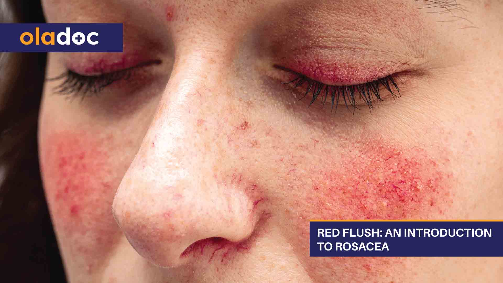 Red Flush: An Introduction to Rosacea | Beauty and Skin Care | oladoc.com